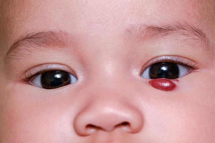 Strawberry Birthmark On Babies: Types, Causes And Treatment ...