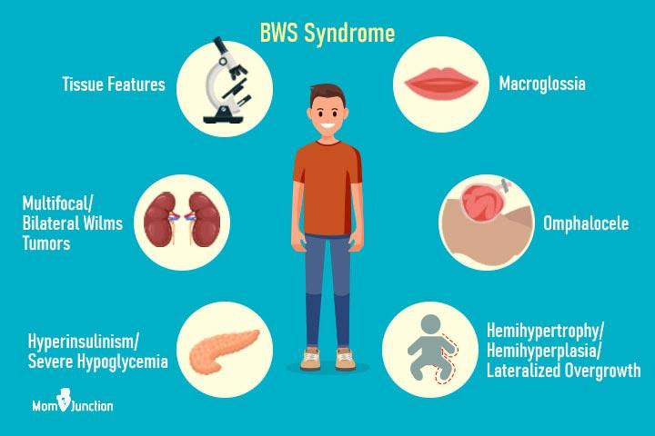 Beckwith-Wiedemann Syndrome: Symptoms, Causes And Treatment - ParentsAndMore.com