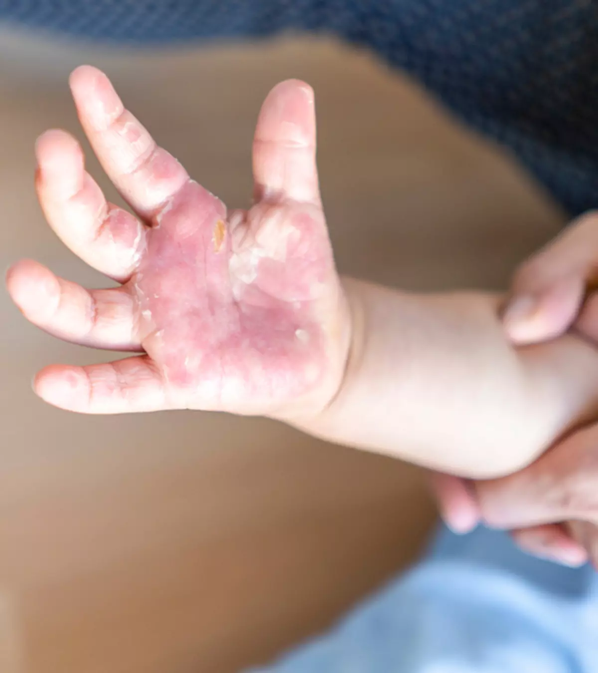 Burns In Children: Guide To Types, Treatment & Prevention