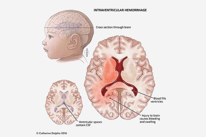 Intraventricular Hemorrhage In Newborns: Causes & Treatment