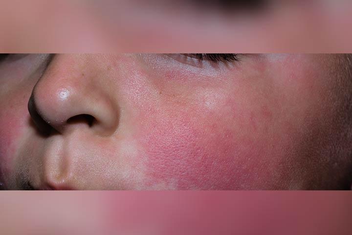 Viral Rash On Face