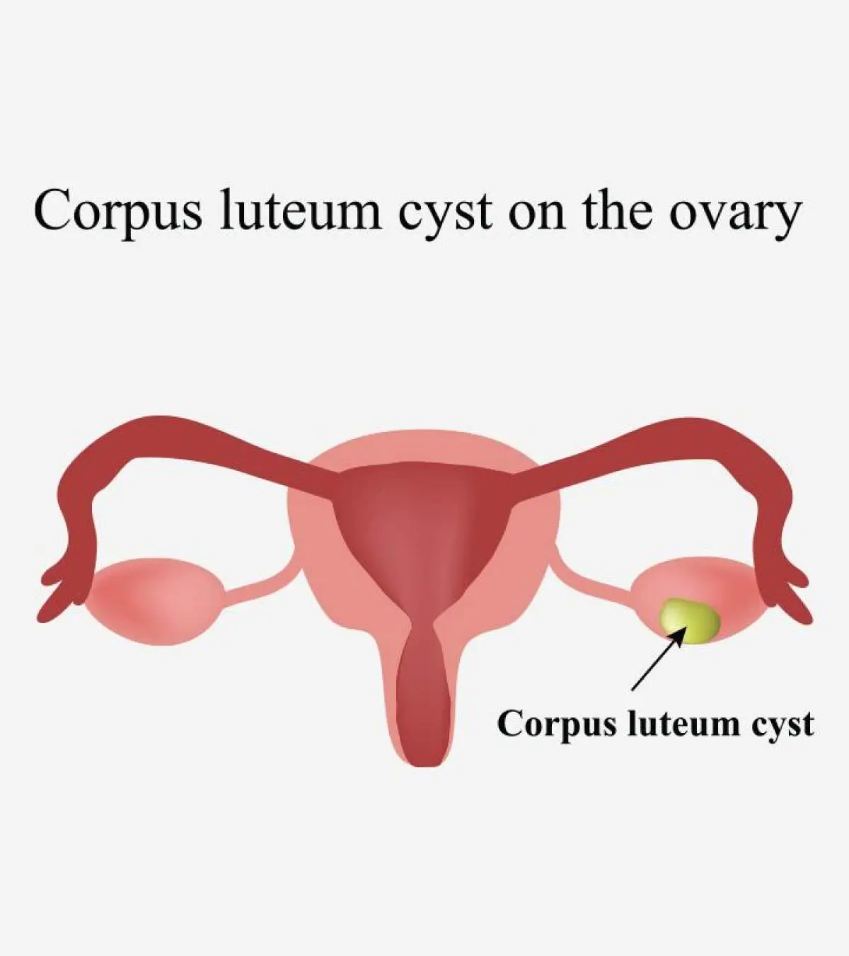 Corpus Luteum Cyst In Pregnancy: Causes, Symptoms, Treatments