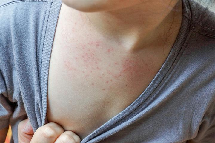 Roseola In Children: Symptoms, Causes, Treatment & Prevention