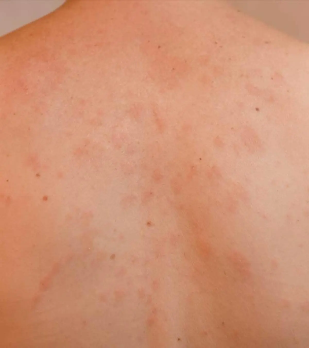 Pityriasis Rosea In Children: Symptoms, Causes And Treatment