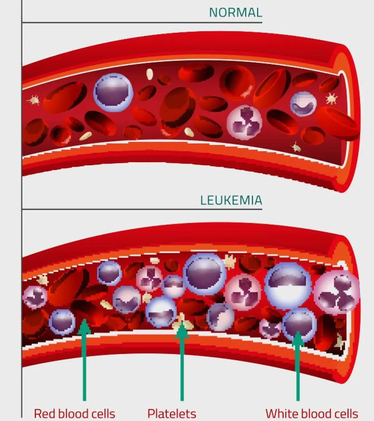 Leukemia In Teens: Key Insights On Symptoms And Treatment