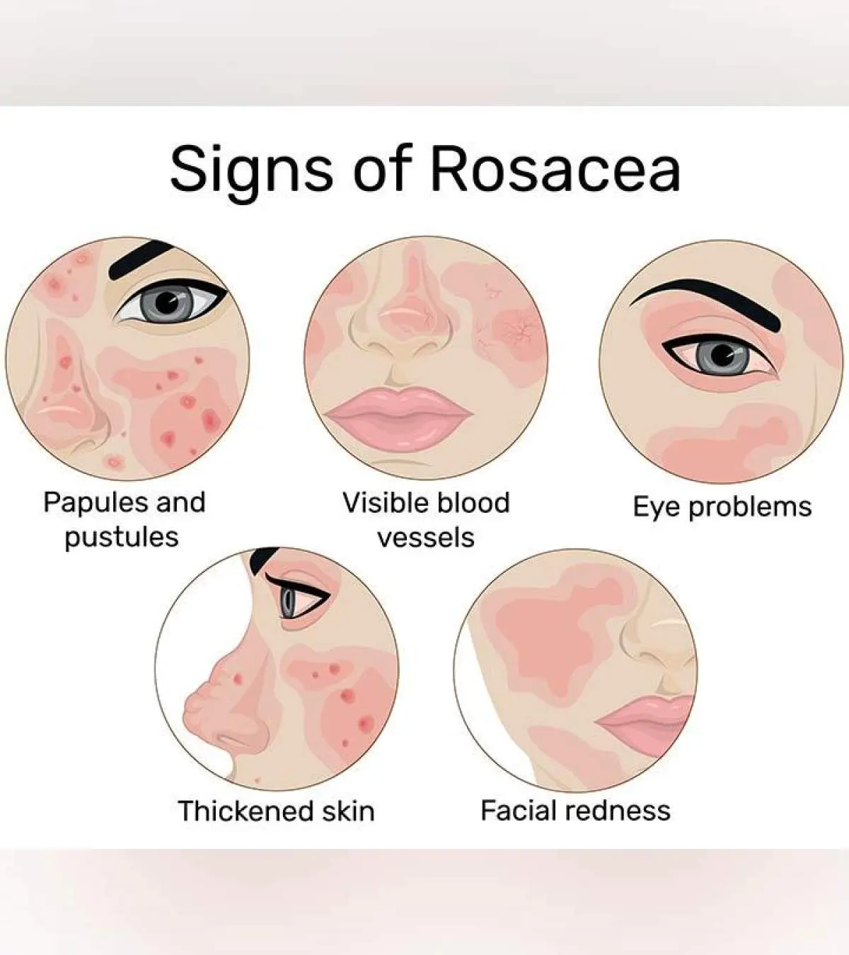 Rosacea In Children: Causes, Symptoms, Treatment & Prevention
