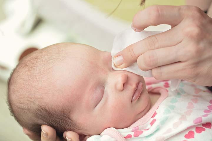 7 Causes Of Sticky Eyes In Newborn Babies And Treatment