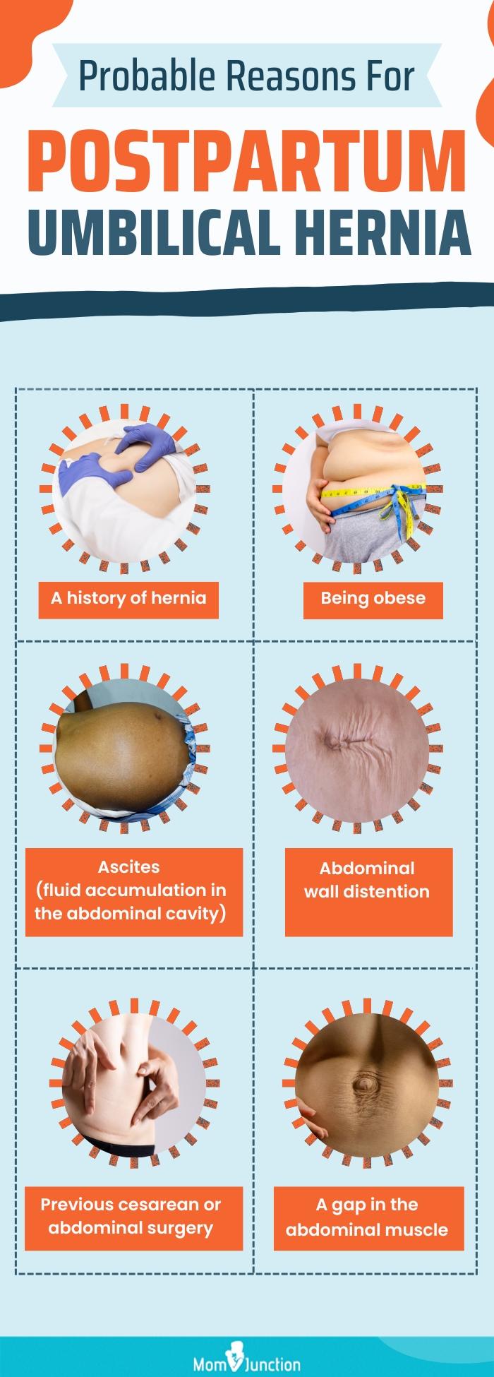 Umbilical Hernia In Women After Pregnancy