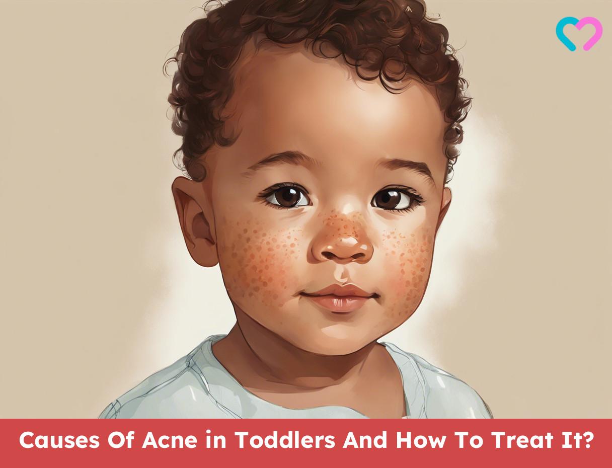 5 Causes Of Acne in Toddlers And How To Treat It? | MomJunction