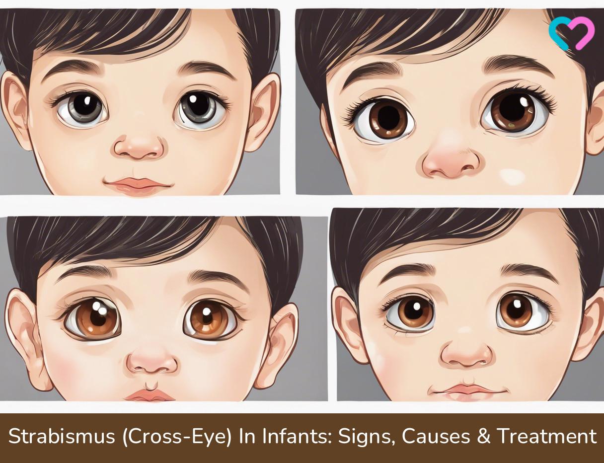 Strabismus (Cross-Eye) In Infants: Signs, Causes & Treatment | MomJunction